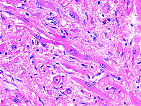 Pathology Outlines Rhabdomyoma 1502x1125
