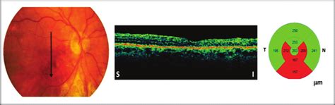 Case 1 Six Weeks After Posterior Vitrectomy With Subretinal Rtpa Download Scientific Diagram