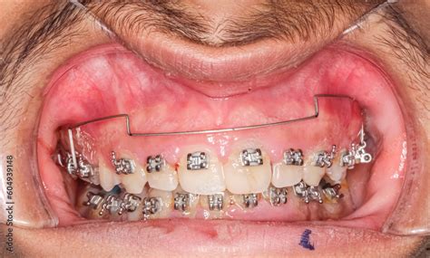 Frontal View Of Dental Arches In Biting Teeth Occlusion Orthodontic Braces Elastic O Ring