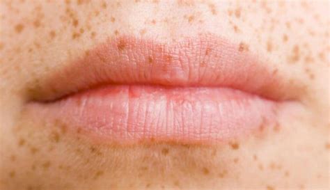 Xeroderma Pigmentosum What Is Xeroderma Pigmentosum