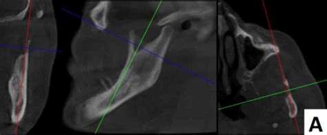 Planes Of Reconstruction In Multiplanar Reformatting A And The