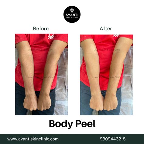 What Is Q Switch Laser Treatment Benefits Results More