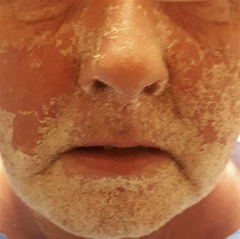 Image Demonstrating The Oatmeal Dermatitis Affecting The Patients Oral