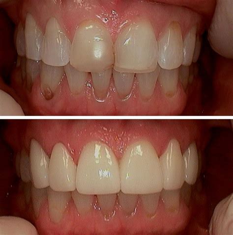 Smile Gallery Fort Mill Sc Jasper Dentistry