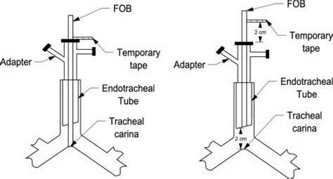 Endobronchial Blocker Tube At Rs 9500piece Electronic Tubes In