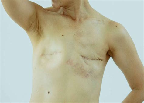 Lumpectomy Vs Mastectomy Making Your Decision