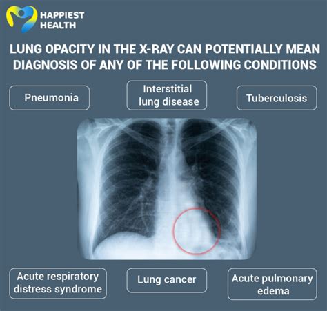 Lung Opacity All About Cloudy Lungs Happiest Health