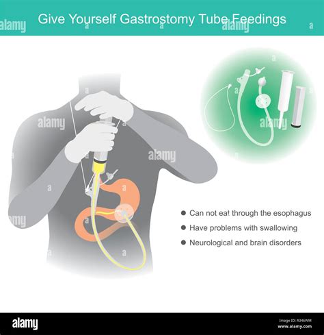 Janeway Gastrostomy Tube