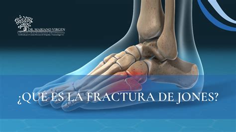 ¿qué Es La Fractura De Jones Dr Mariano De Jesús Virgen León