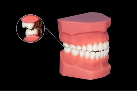 Class 1 Bite Benefits And How Aligner32 Can Help