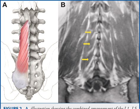 Lumbar Paraspinal Muscles Anatomy Radiology