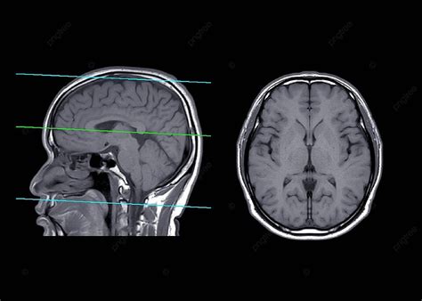 พื้นหลังเปรียบเทียบการสแกนสมองด้วยคลื่น Mri แบบแกนและแนวขวาง รูปถ่าย