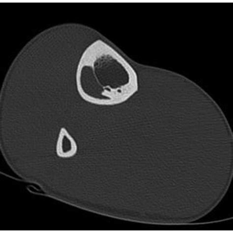 Axial Ct Image Demonstrating An Osteolytic Lesion In The Lateral Tibial