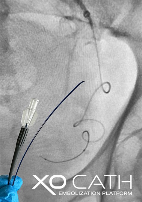 Transit Scientific Introduces Xo Cath Embolic Delivery Microcatheter Endovascular Today