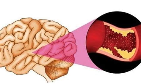 Brain Ischemia Market To Witness Fabulous Growth With Edwards