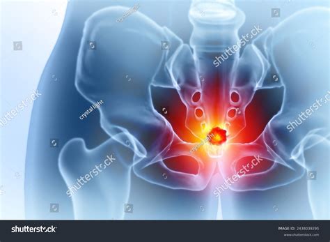 Pelvic Bone Cancer Tumor 3d Illustration Stock Illustration 2438039295 Shutterstock