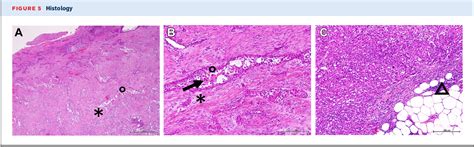Figure 5 From Metastatic Penile Squamous Cell Carcinoma Semantic Scholar