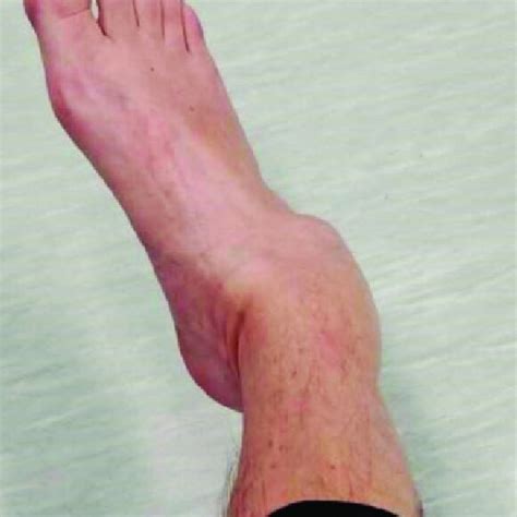 Initial Radiograph Of The Right Ankle Showing Talus Dislocation Without