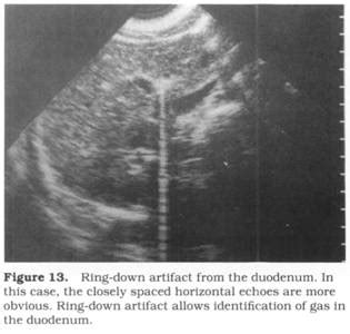Comet Tail Effect Hay Ring Down Artifact