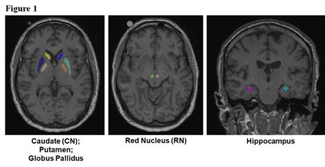 Automatically Segmented Regions Of Interest Caudate Cn Putamen