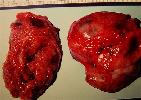 Goiter Surgery Photos