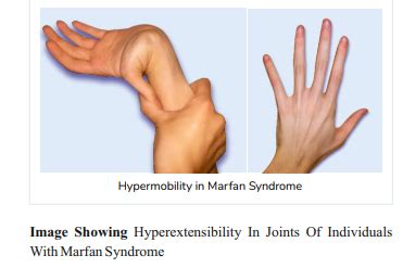 Marfan Syndrome Signs Diagnosis Clinical Manifestations