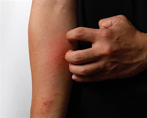Swollen Lymph Nodes Hiv Symptoms