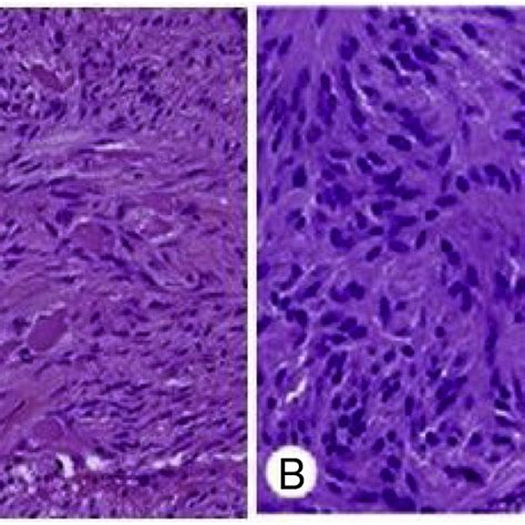 Hist Wide Spectrum Of Histologic Features Of Gastric Gist A Download Scientific Diagram