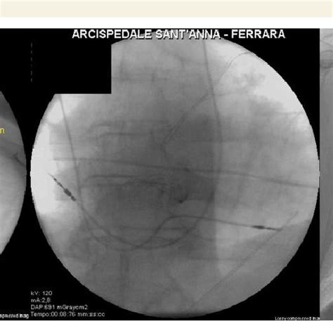 Left Panel Venography Contrast Injection From Left Arm Shows