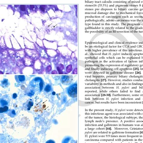 Bismuth Corlette Staging System Type 1 2 3a 3b And 4 Tumors Download Scientific Diagram