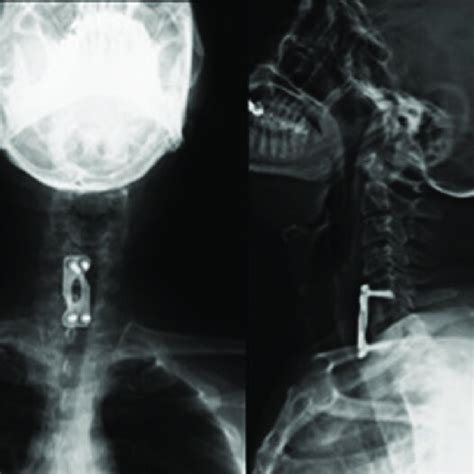Plain Radiographs Showing C6 Corpectomy With C5 C7 Fusion And Anterior