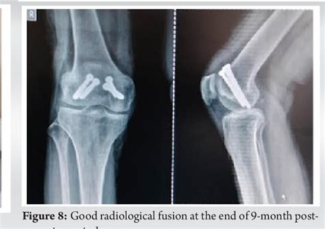 Figure 8 From Missed Medial Condyle Hoffa Fracture In A Case Of Lateral Condyle Hoffa Fracture