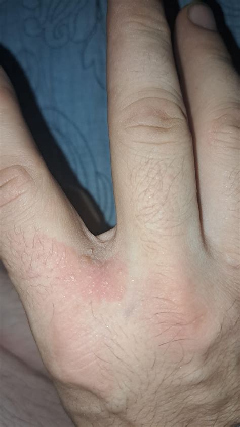 Rash Between Fingers That Are Blistering It Seems Like I Had Popped