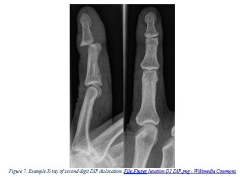 Hand And Finger Dislocation Emergency Care Bc