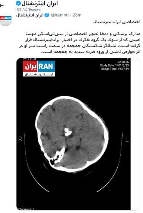 انتشار سی تی اسکن مهسا امینی Gooya News