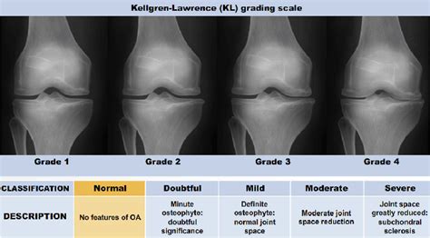 Osteoarthritis Program Ancillary Program Progressus Revenue
