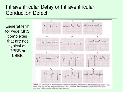 PPT Ventricular Conduction Disturbances PowerPoint Presentation Free Download ID 808438