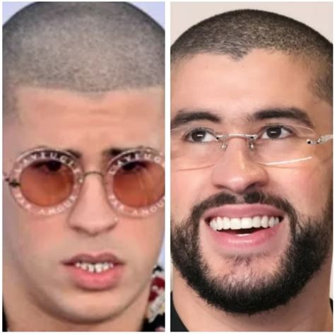 Famous Celebrities With Dental Veneers And Amazing Smiles