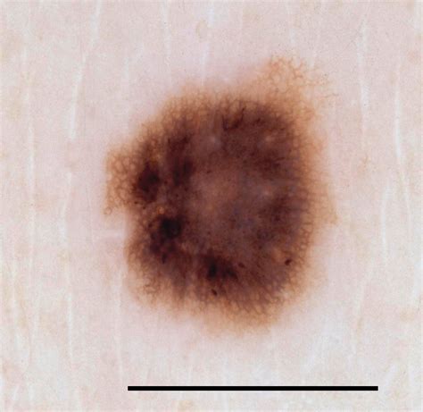 Pictures Of Dysplastic Nevi Dysplastic Nevus And Spitz Nevus Zzgh