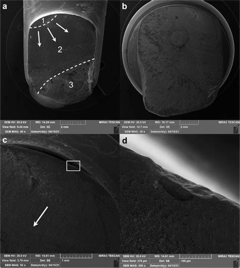 An Extremely Rare Case Of Cementless Third Generation Corail Stem Neck Fracture With