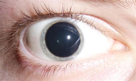 File Dilated Pupils 2006 Cropped 2  Wikimedia Commons