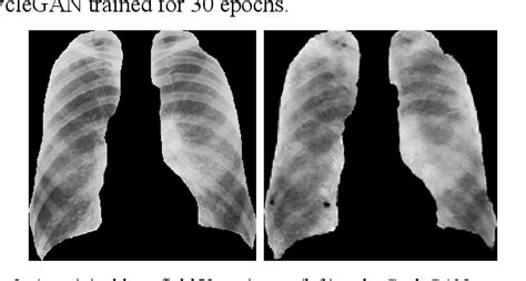 Figure 4 From Automated Pneumoconiosis Detection On Chest X Rays Using Cascaded Learning With