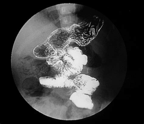 A Shorter Loop In Roux Y Hepatojejunostomy Reconstruction For