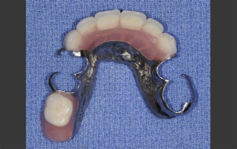 Maxillary Removable Partial Denture