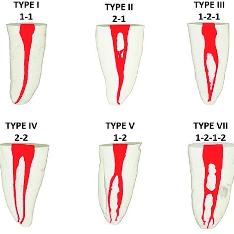 Vertuccis Classification By Micro Ct Observed In Mandibular Premolars