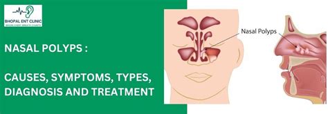 Nasal Polyps Treatment In Bhopal Dr Shalini And Dr Sadat