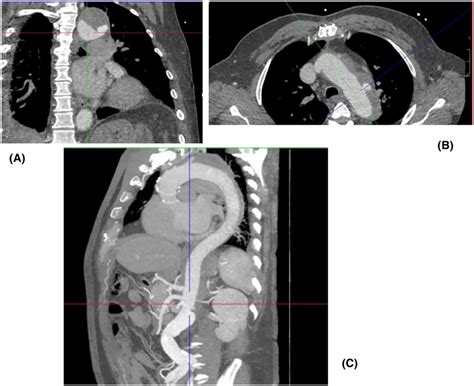 Ct Aortic Angiogram Showing Frontal A Transverse B And Download Scientific Diagram