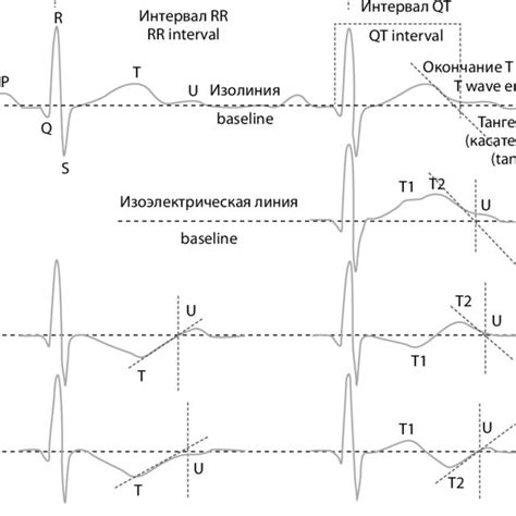 QT Interval Estimation With Tangent Method Download Scientific Diagram