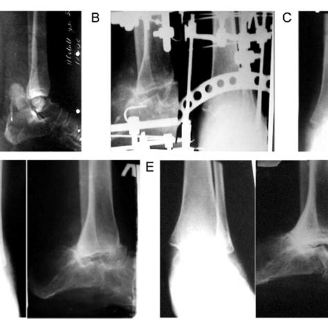 Radiographs Of Patient S A Closed Fraction Dislocation Of The Talus