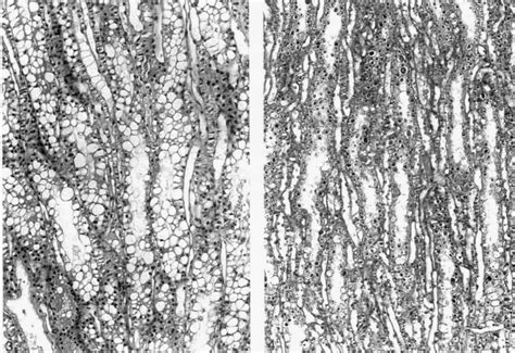 Marked Vacuolation Of Medullary Collecting Duct Epithelial Cells